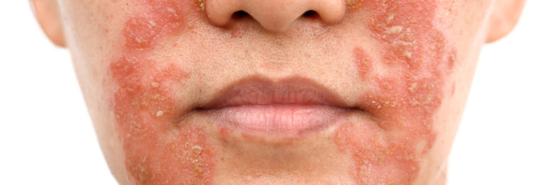 Comment mieux traiter le psoriasis du visage?